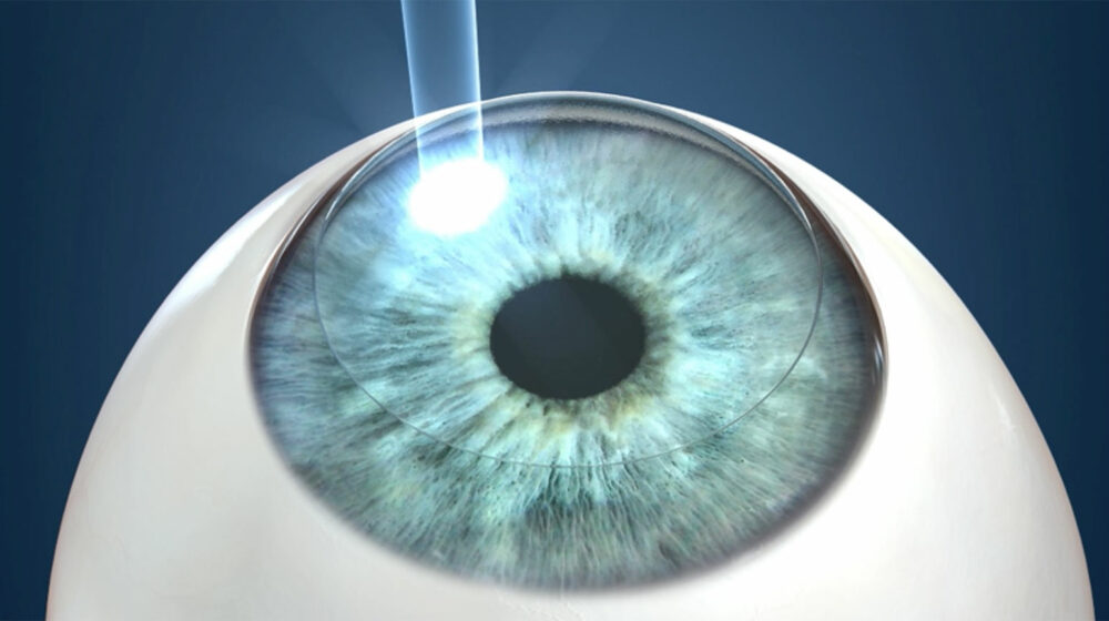 What Is Refractive Surgery? | Carolinas Center for Sight